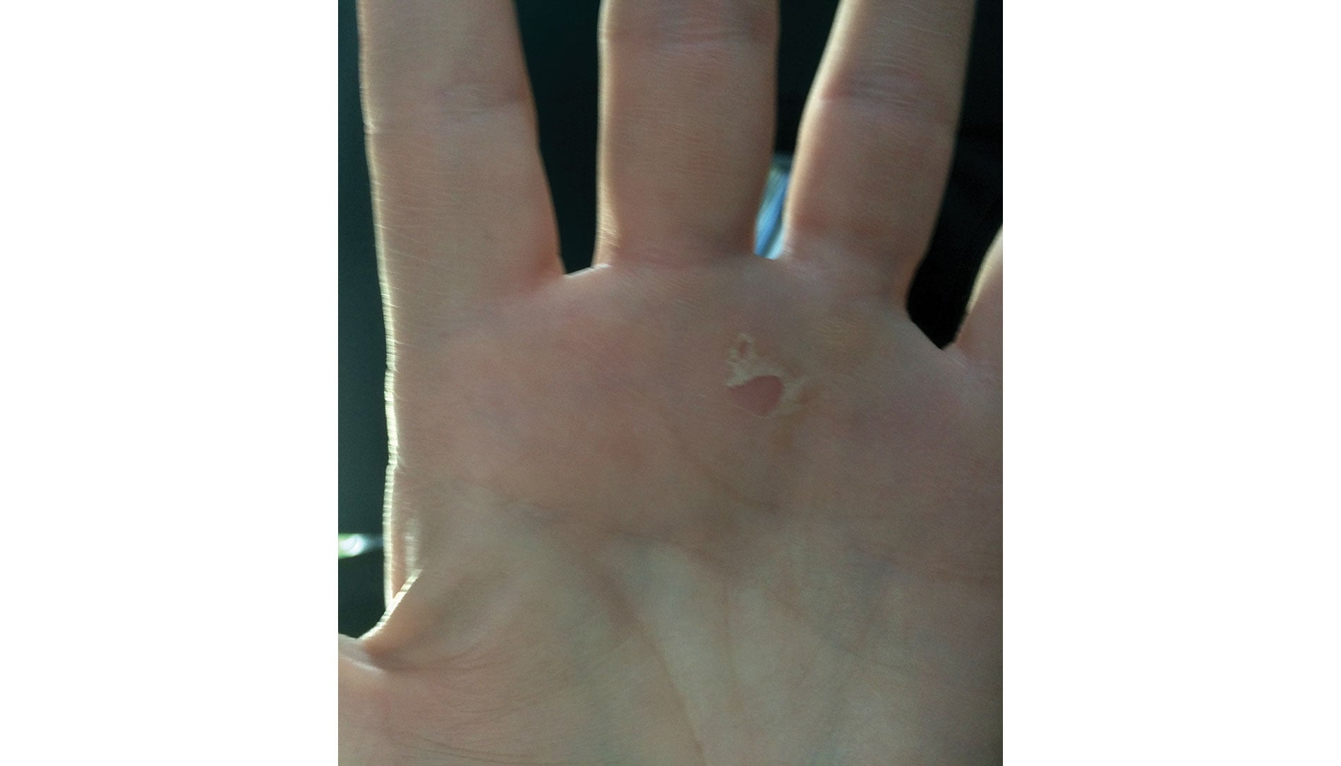 Burning Up: Arc Flash, Second-Degree Burns and a Chili Cookoff ...