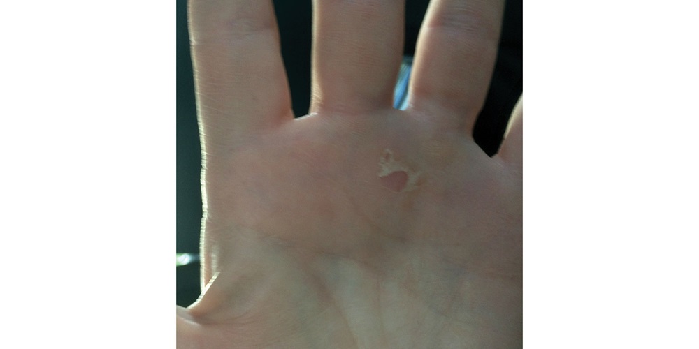 Burning Up: Arc Flash, Second-Degree Burns and a Chili Cookoff ...